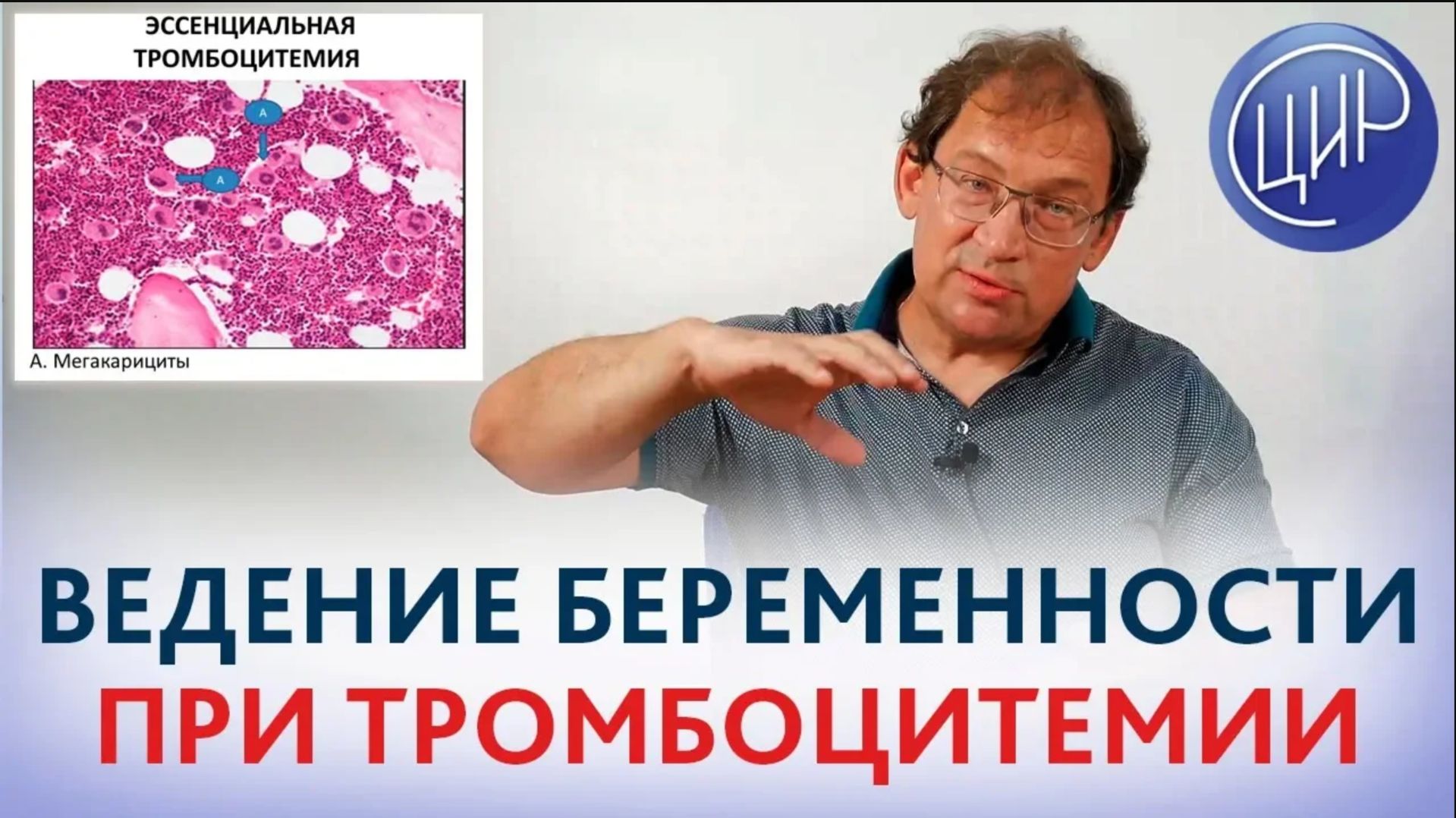 Эссенциальная тромбоцитемия и другие миелопролиферативные заболеваниях и беременность.