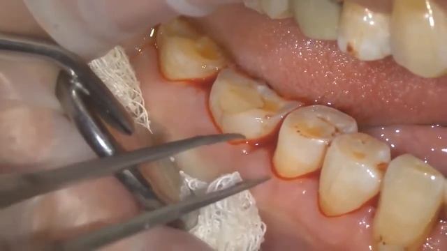 M-Chip наноматрица как правильно устанавливать