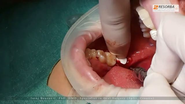 Parasorb применение дентального конуса при удалении зуба.