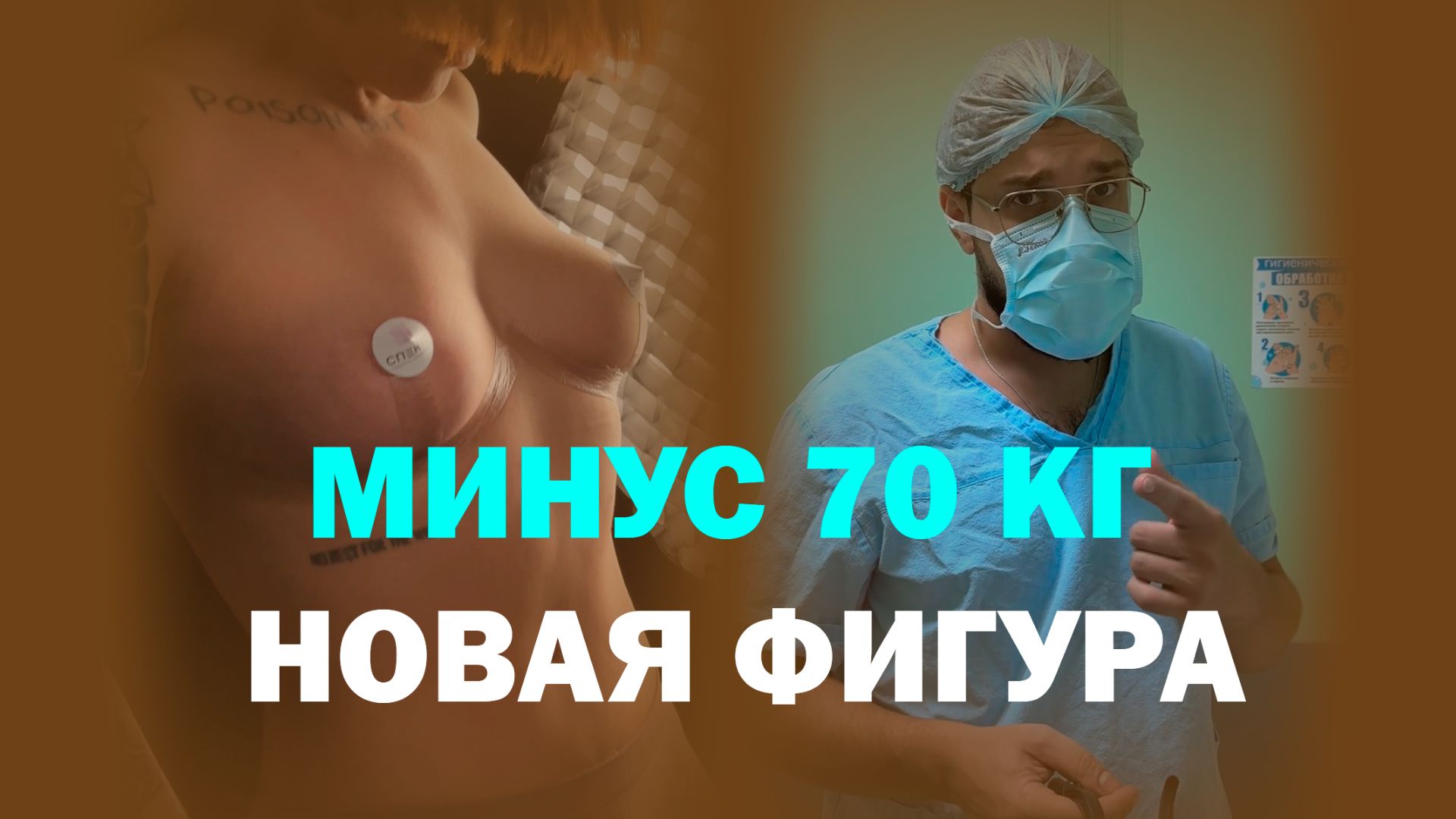 Масштабное преображение после снижения веса: липободилифт и маммопластика