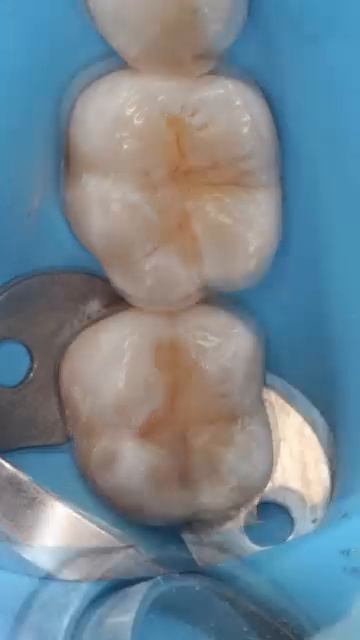 Вы бы заметили этот кариес? #кариес #лечениекариеса  #фиссурныйкариес #стоматология #пломба