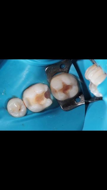 Реставрация зуба: ДО/ПОСЛЕ #реставрациязубов #кариес #пломба #жевательныезубы #допосле #новосибирск