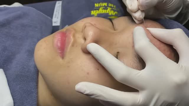 Процедура удаления прыщей в спа-салоне