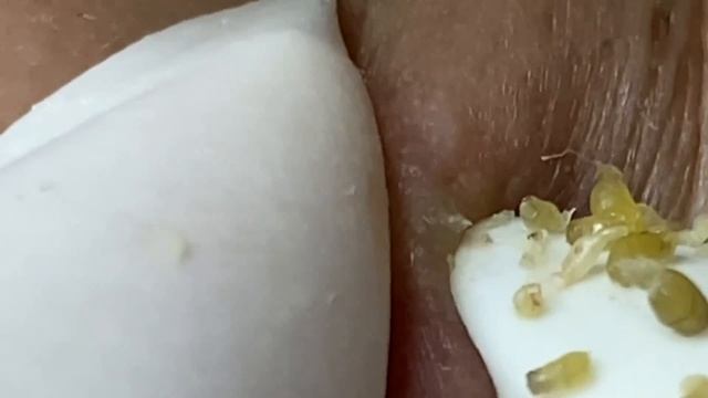 Эффективное удаление акне и прыщей