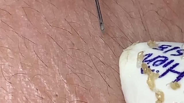 Убирание красных и болезненных прыщей