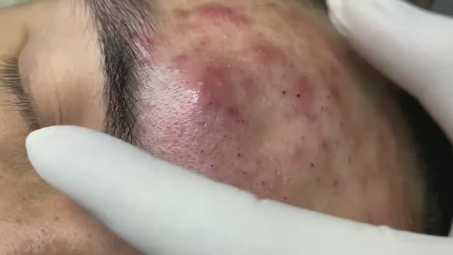 Очищение кожи от прыщей для здоровья и красоты