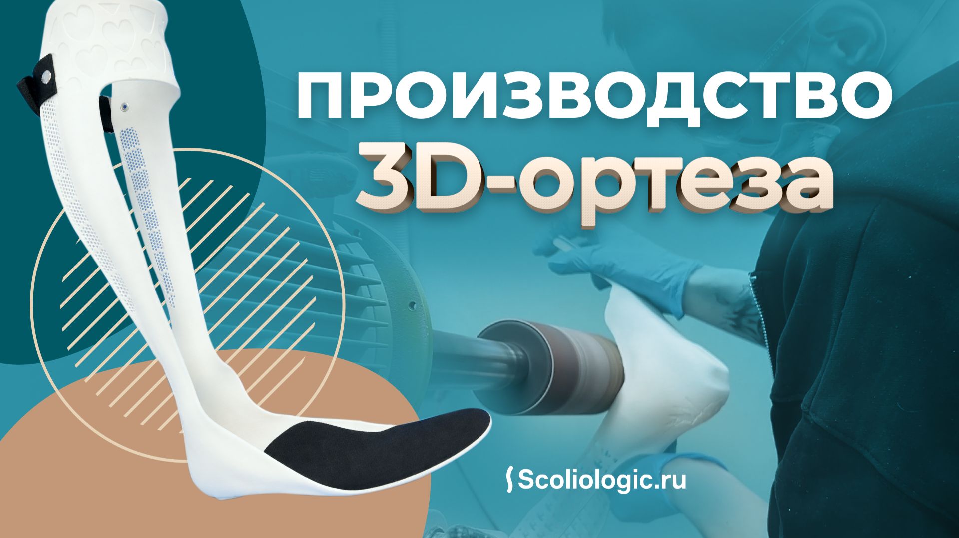 Ортезы, напечатанные на 3D-принтере. Лучше или хуже?