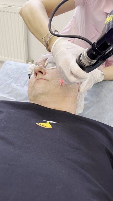 Лазерная шлифовка при рубцах постакне. Лазер Dermablate