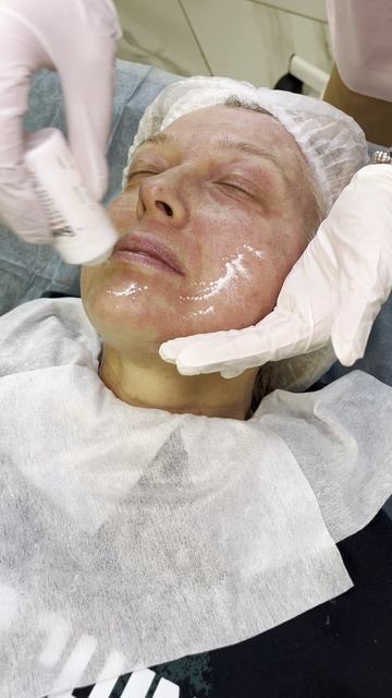 Фракционный фототермолиз на немецком лазере Asclepion