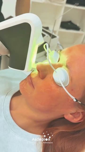 QuadroStar Pro Yellow  - лечение купероза, розацеа и различных сосудистых патологий