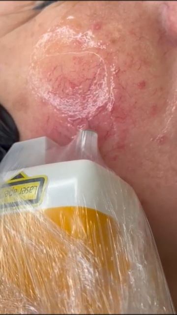 насадка VAS. Технология работы при работе с куперозом, сосудистыми капиллярами и звездочками.