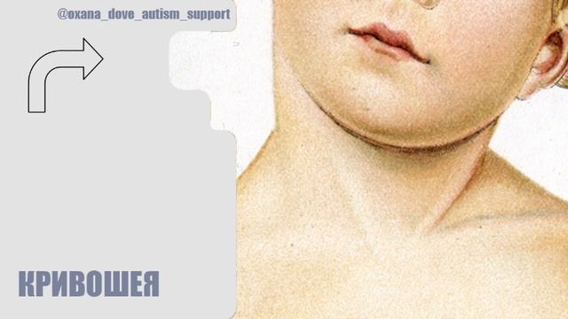 АУТИЗМ. КРИВОШЕЯ