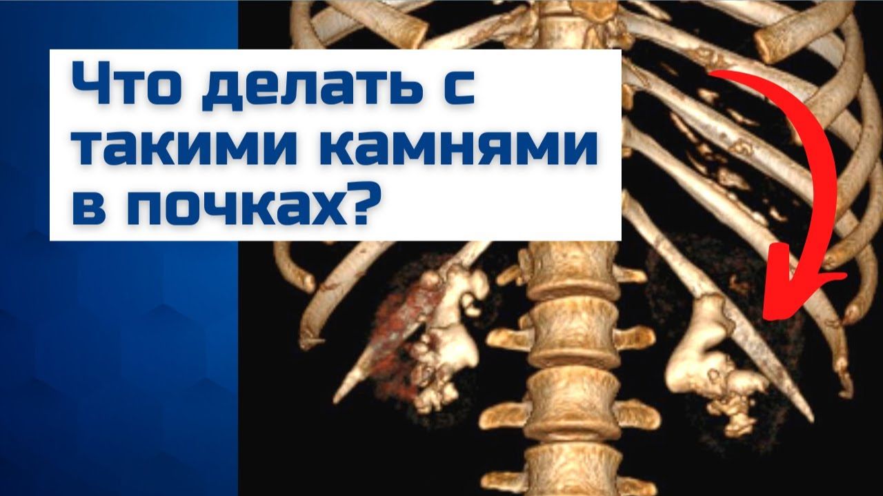 Мучают частые циститы или повышенная температура Причиной могут быть коралловидные камни в почках