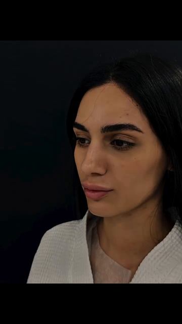 Результат ринопластики от доктора Абрамова Валентина Андреевича