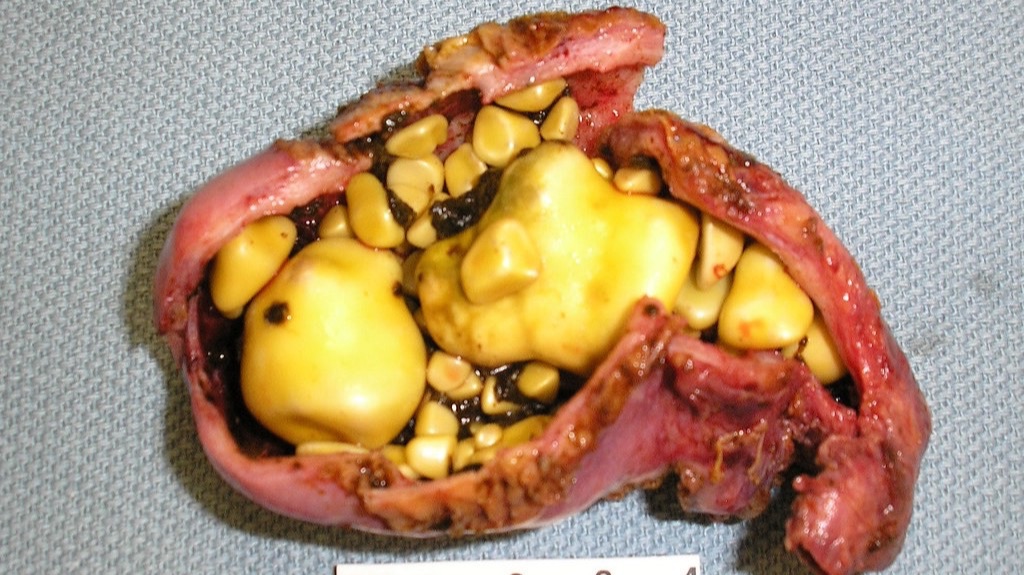Патология поджелудочной железы, жёлчного пузыря, брюшины