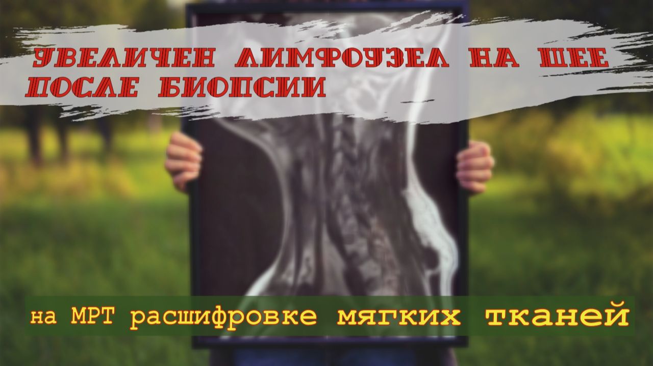 Подчелюстные ЛИМФАТИЧЕСКИЕ УЗЛЫ УВЕЛИЧЕНЫ после БИОПСИИ лимфоузлов на МРТ расшифровке ВТОРОЕ МНЕНИЕ