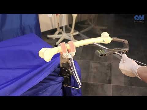 ОСТЕОМЕД®️ Шеечный и деротационный винт Установка. Проксимальный бедренный Y - штифт.