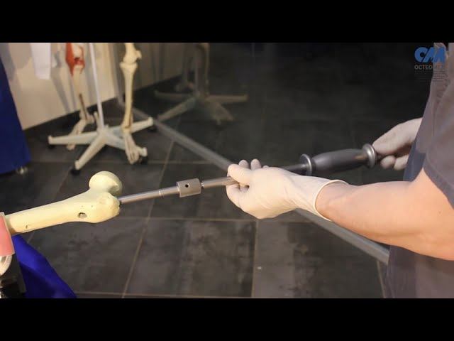 ОСТЕОМЕД®️ Шеечный и деротационный винт Удаление. Проксимальный бедренный Y - штифт.