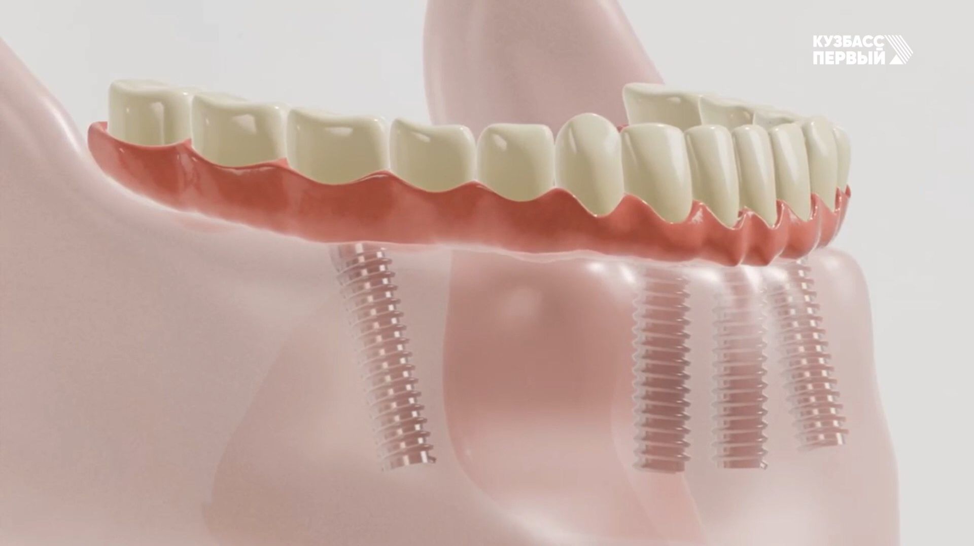Здоровая улыбка России. Сколько служит имплант и как часто нужно менять коронку?