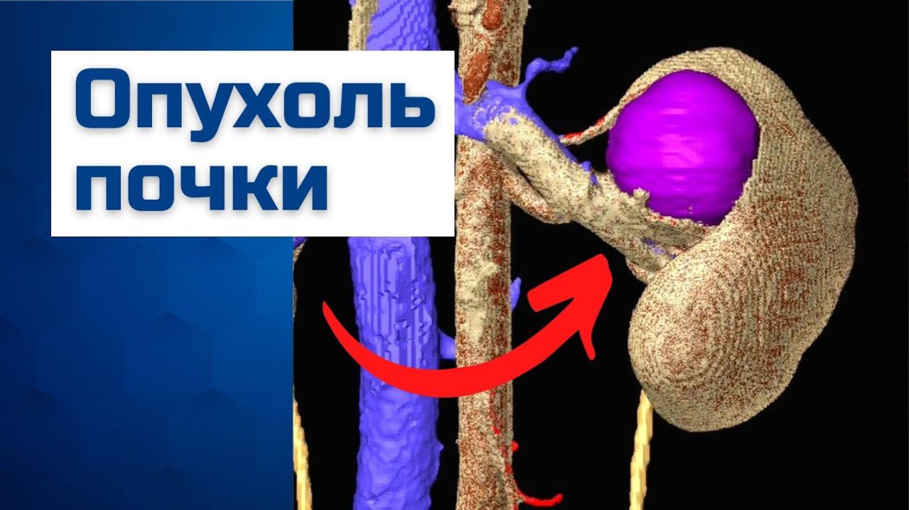 Удаление опухолей почек | Разбор 4-х пациентов