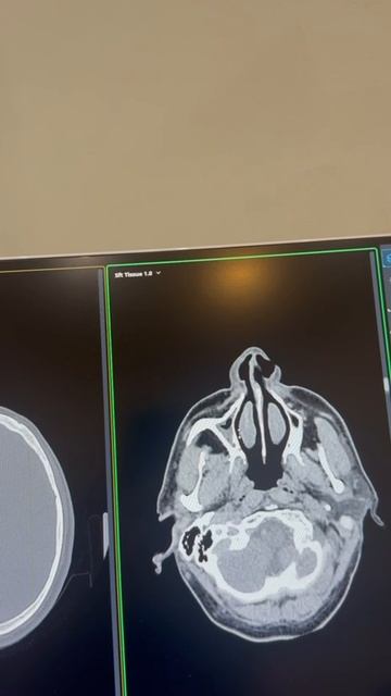 Заглянем со мной в полость носа и пазухи пациента?🤓