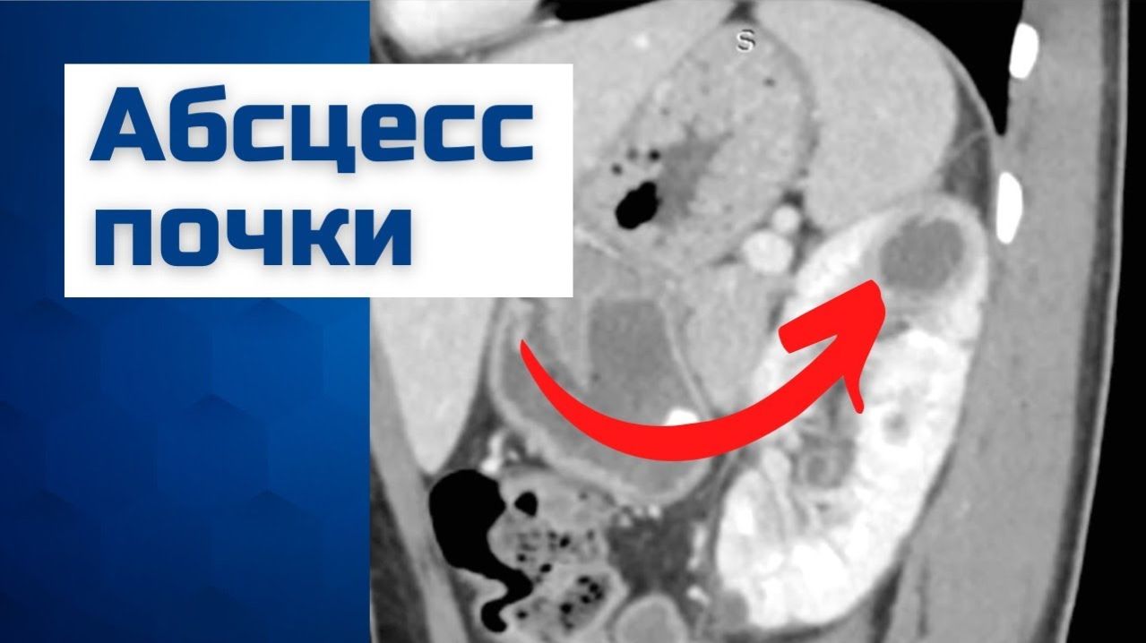 Абсцесс почки | Или что бывает, если вовремя не обращаться к врачу с почечной коликой