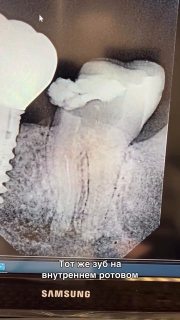 КЛКТ или снимок? Хватит путать! #эндодонтия #клтк #рентген #пульпит #периодонтит #shorts #медицина