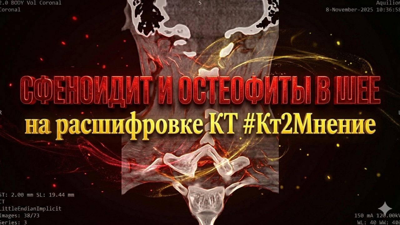 Аномалия Киммерли, ОСТЕОФИТ, сфеноидит, СЕРНАЯ ПРОБКА в ухе при БОЛИ в области шеи на КТ расшифровке