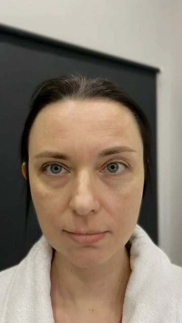 #блефаропластика: спустя 5 дней