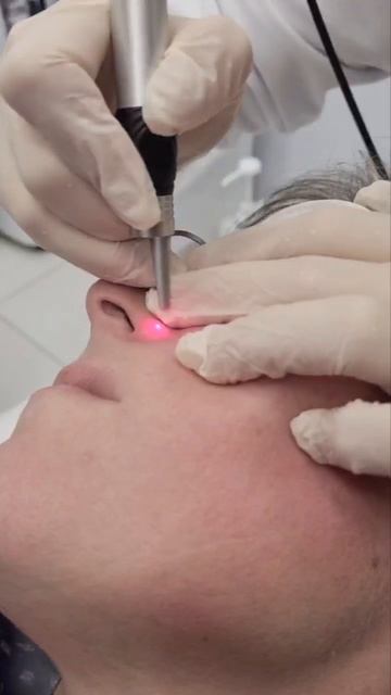 Удаление сосудов на крыльях носа. Быстрая, безопасная процедура.