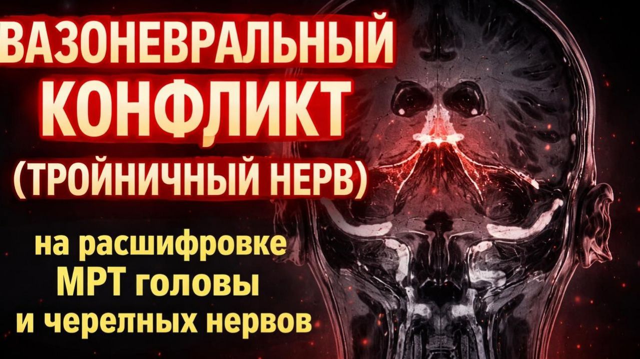 ТРОЙНИЧНЫЙ НЕРВ лица, ПЛОХОЕ КРОВОСНАБЖЕНИЕ мозга, ГИПОПЛАЗИЯ позвоночной артерии на расшифровке МРТ