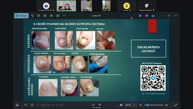 Системы коррекции деформации ногтей - различия, показания,противопоказания