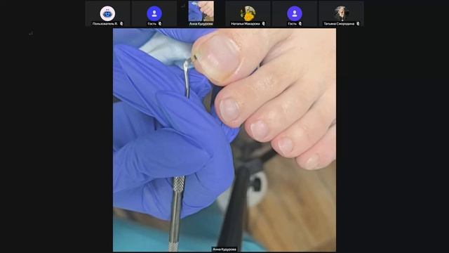 Тампоны в подологии. Плюсы работы с сывороткой Enzyme