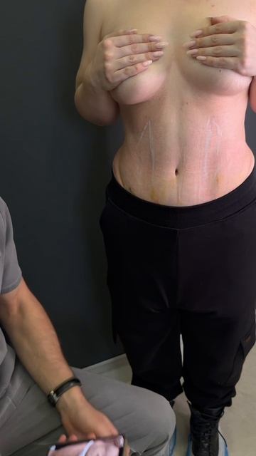 #абдоминопластика: спустя 5 дней после операции