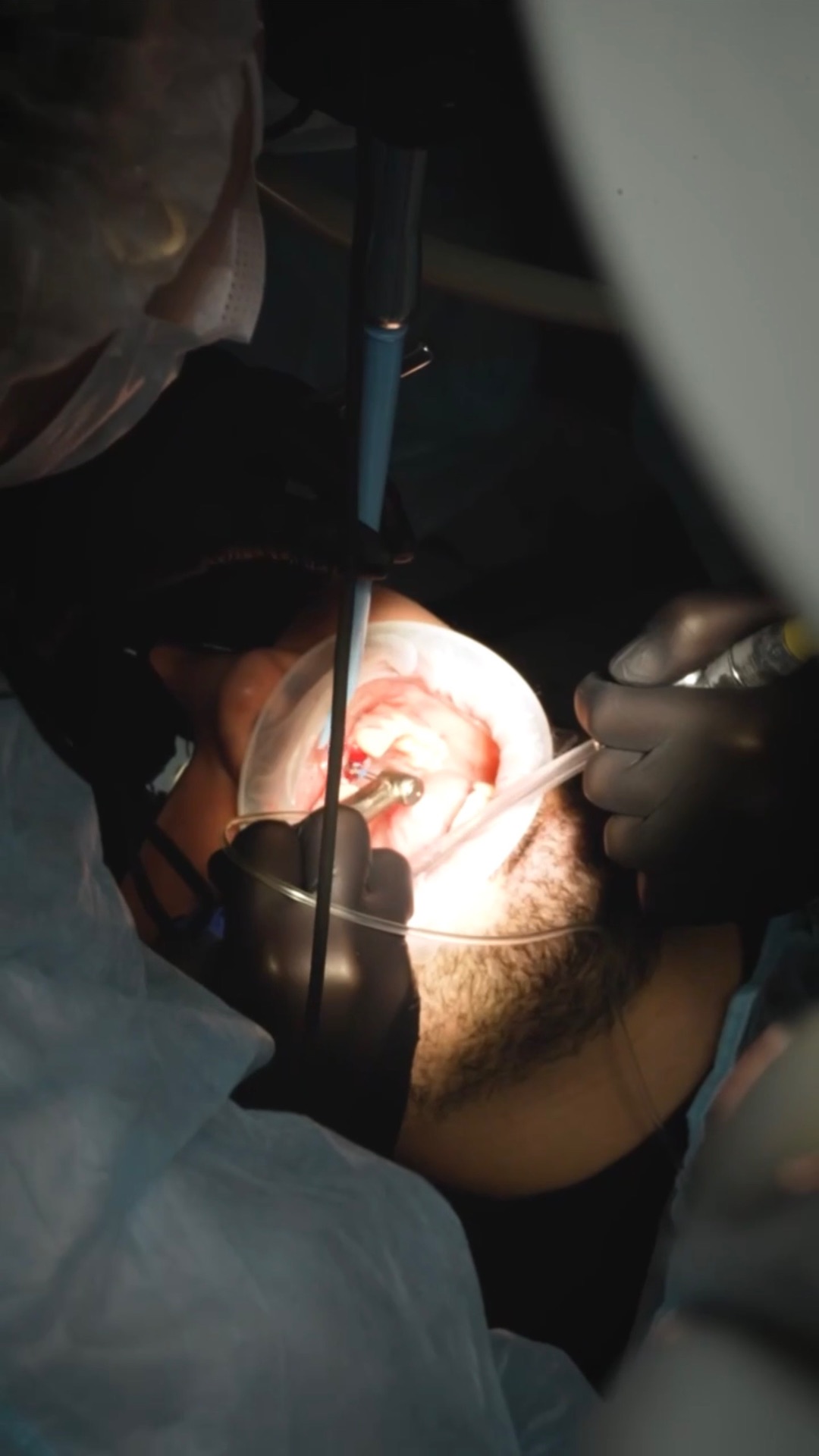 Имплантация глазами врача, это как? 👀