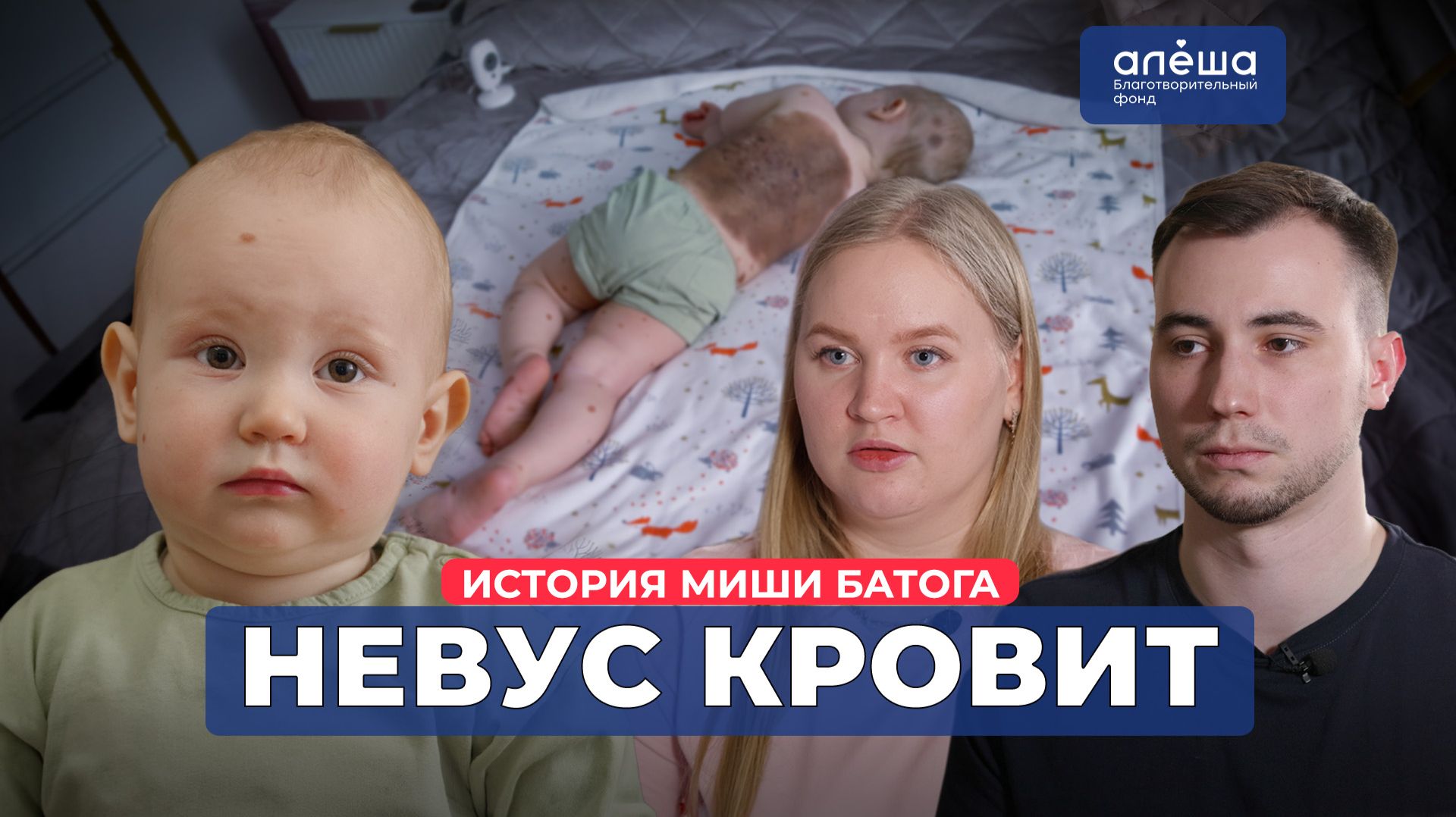 ВРОЖДЁННЫЙ ГИГАНТСКИЙ МЕЛАНОФОРМНЫЙ НЕВУС ТЕЛА | История Миши Батога