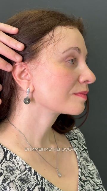 #комплексное_омоложение_лица: спустя 2,5 месяца