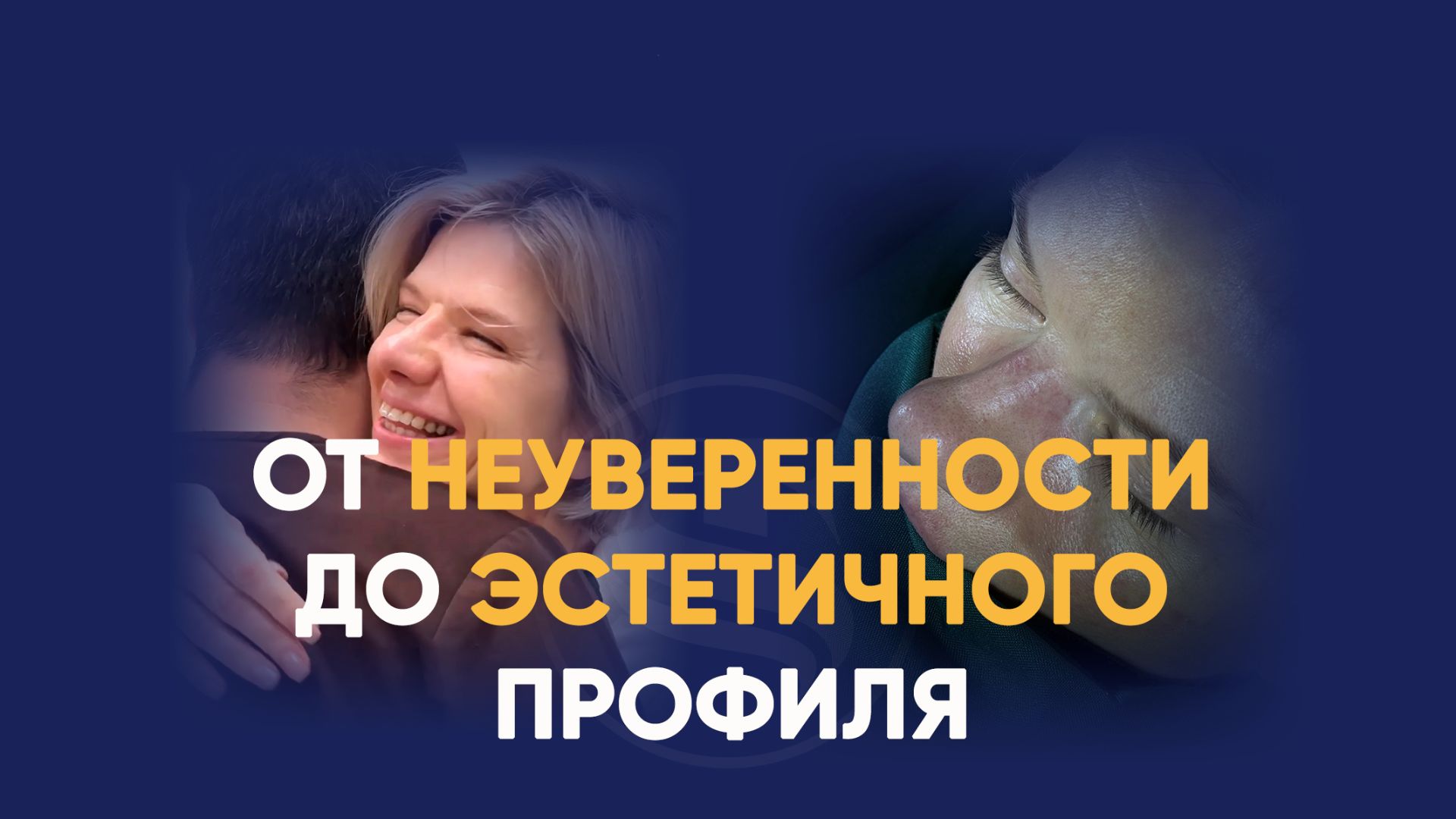 Открытая риносептопластика: сужение носа и коррекция кончика