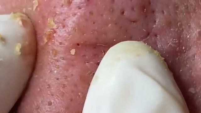 003 • Relax Spa • АСМР • Acne collection