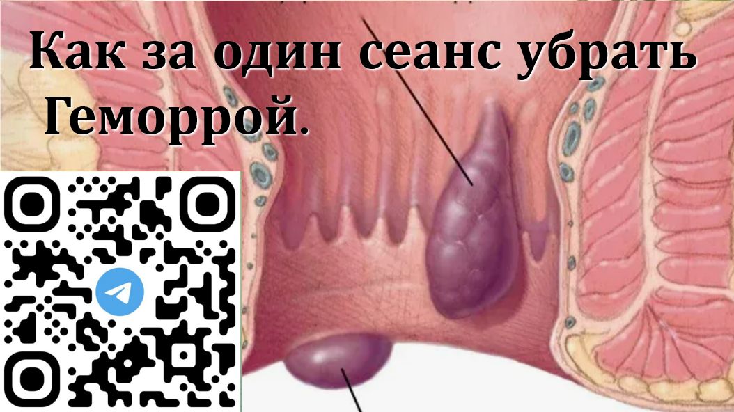 Геморрой - избавилась на один сеанс.