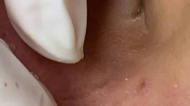 002 • Relax Spa • АСМР • Acne collection