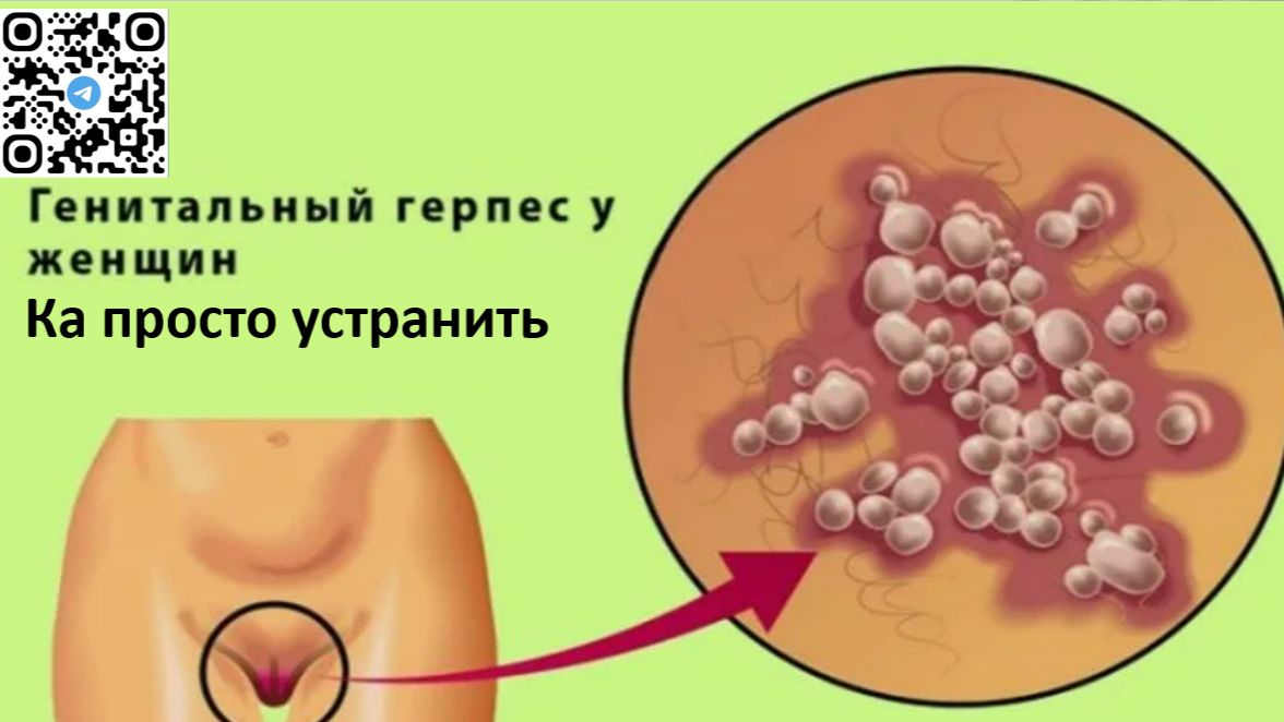 Как я избавилась от генитального герпеса. Мой результат.