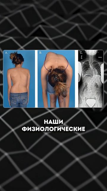 Это самые ОПАСНЫЕ виды СКОЛИОЗА - Проверь СВОЮ СПИНУ прямо СЕЙЧАС!
