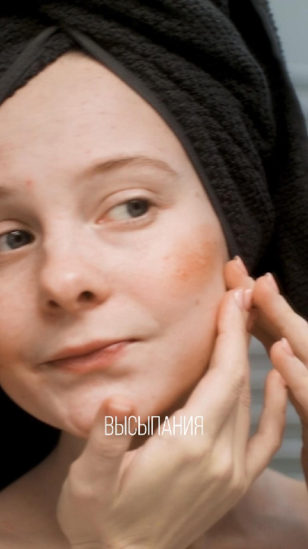 Себорейный дерматит: что это?