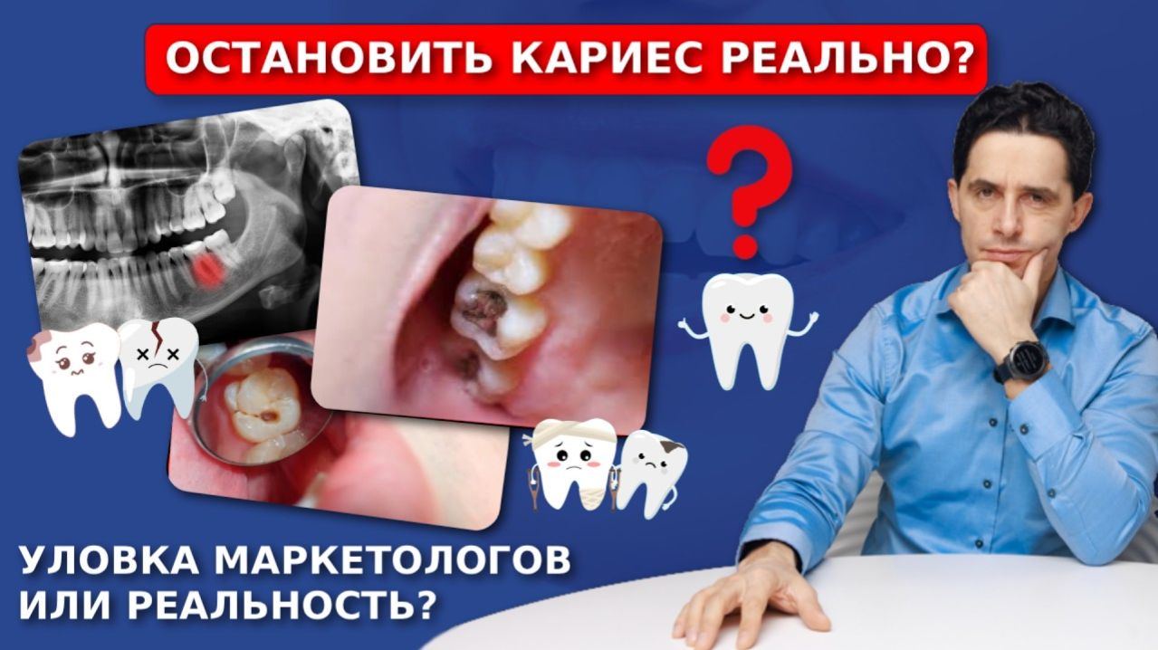 Остановить кариес реально? Разбираемся с врачом, практические советы