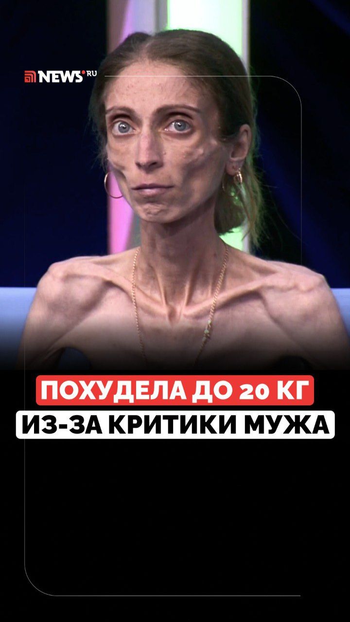 Довела себя до анорексии из-за мужа. Что стало с Яной Бобровой, похудевшей до 20 кг