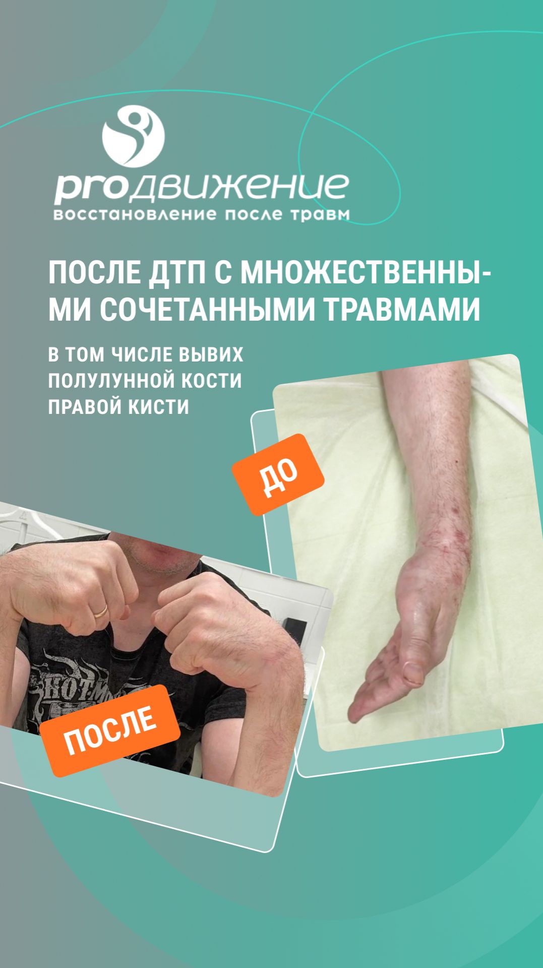 💁♂️ Восстановление после вправления вывиха полулунной кости