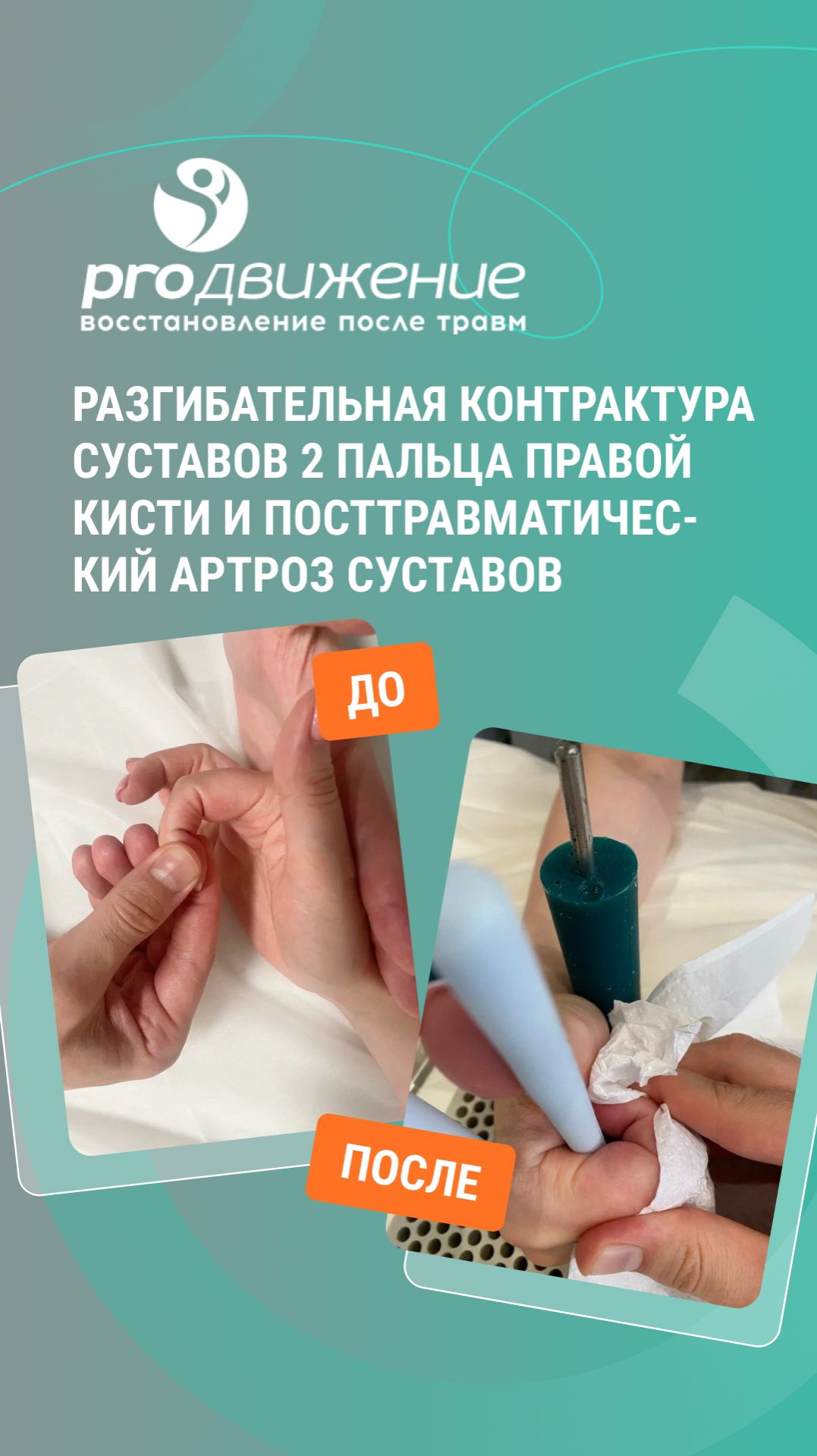 Восстановление функции кисти после травмы: как вернуть гибкость и силу пальцам