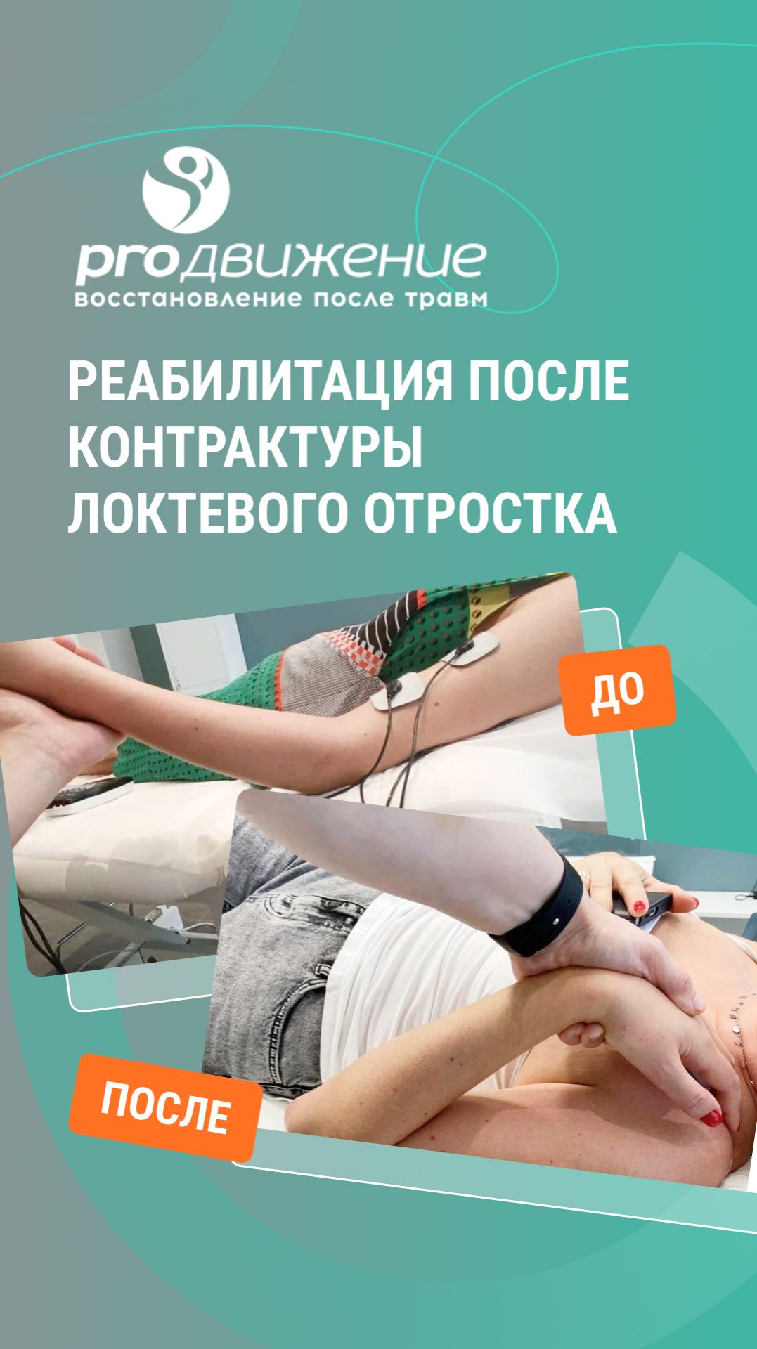 👉 Реабилитация после контрактуры локтевого отростка