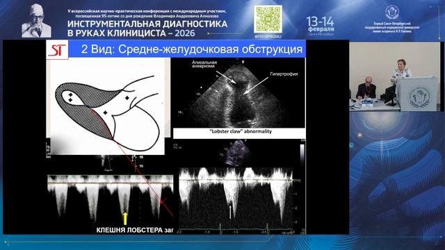 Гипертрофическая кардиомиопатия